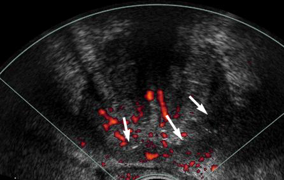 Imaging in Prostate Carcinoma 4- Ultrasonography
