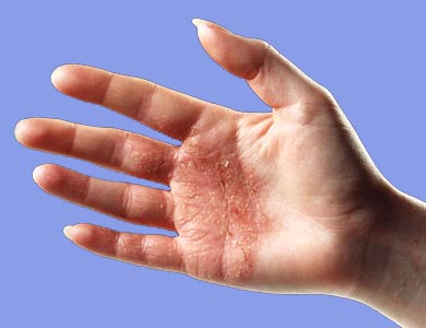 Huismiddeltjes: Uien in de strijd tegen eczeem aan de handen