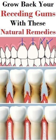 Grow Back Your Receding Gums With These Natural Remedies - HEALTH CAPSULES