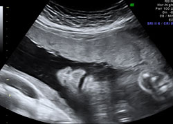 First Choice Baby Scan: 19 Weeks pregnant