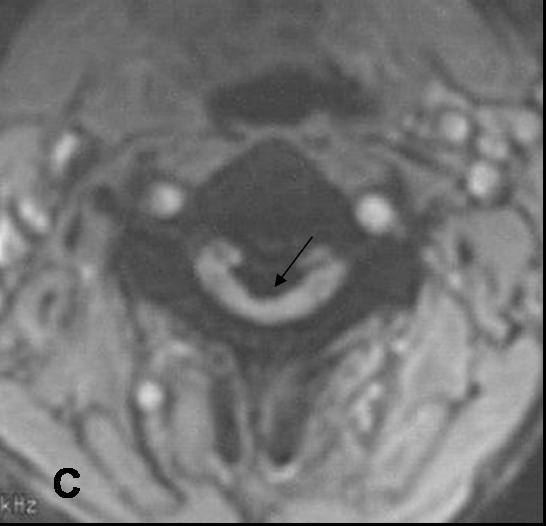 MRI MEDIC CASE STUDIES COLLECTION: Ossification of the posterior ...