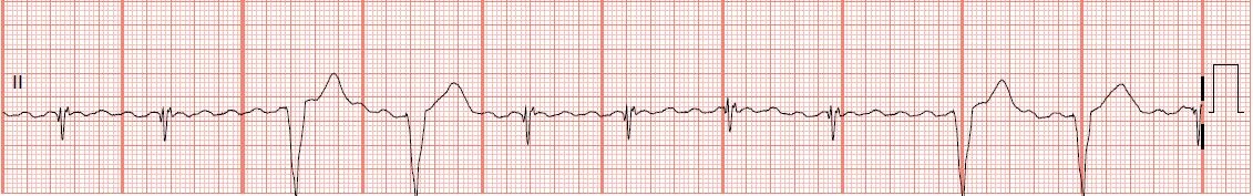EKG Rhythm Strips 55
