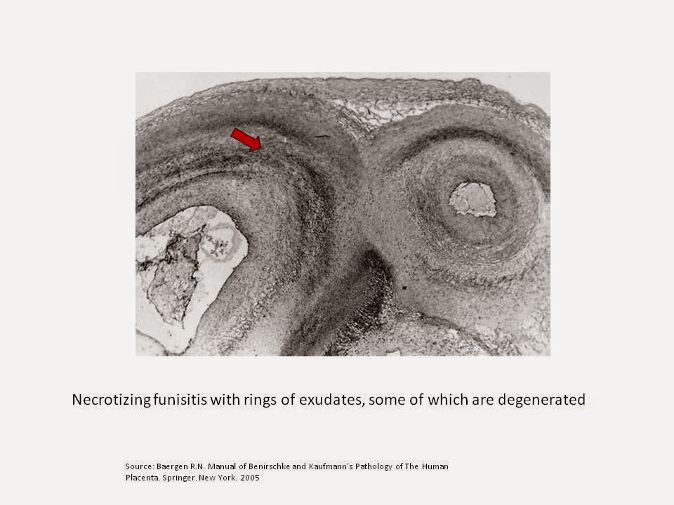 Reza Aditya Digambiro: Chorioamnionitis