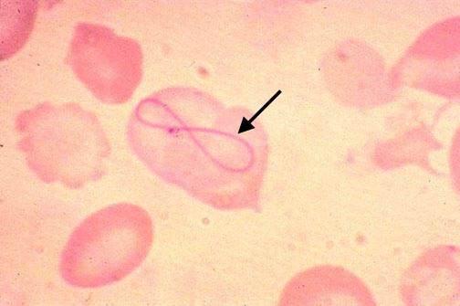 حلقة كابوت (Cabot-Ring)