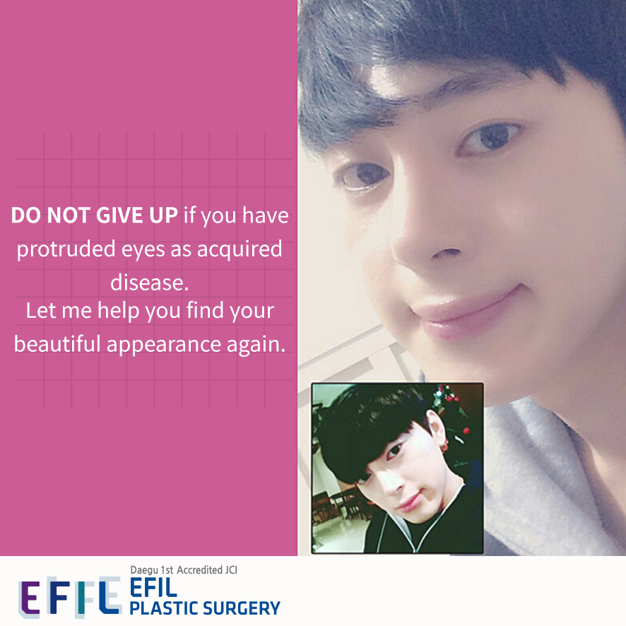 EFIL Bulging Eyes Plastic Surgery JCI: Exophthalmos surgery, protruded ...