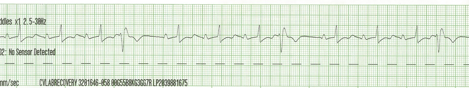 ECG Rhythm Strips 88