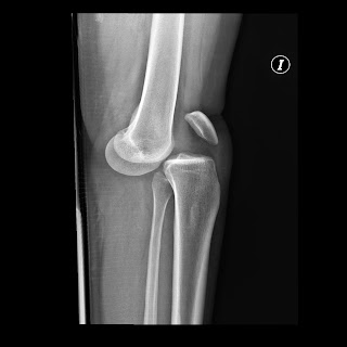 Casos Clínicos e Imágenes Médicas: Luxación anterior de rodilla.