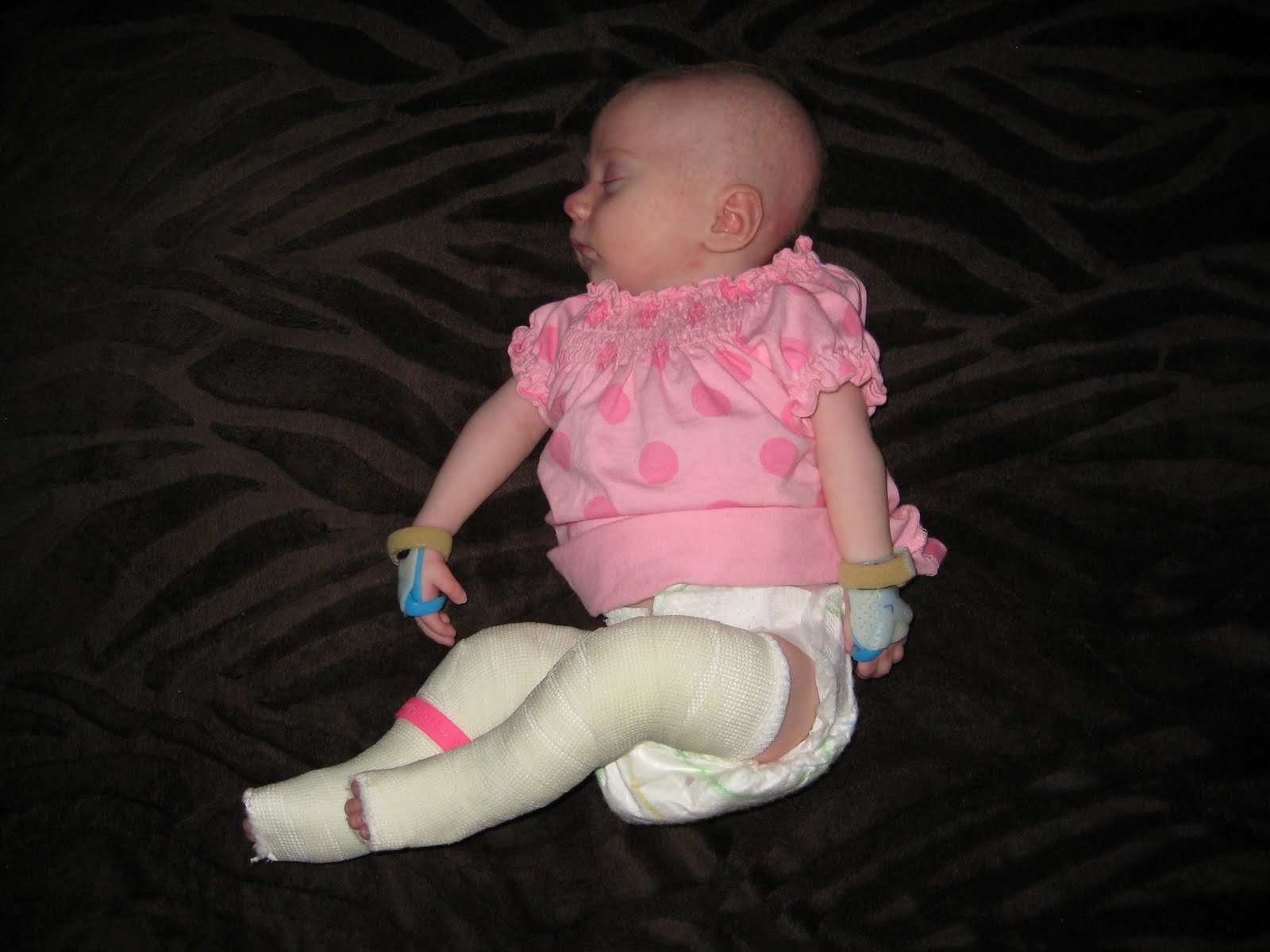Sweet Analise Rose's Journey with Arthrogryposis, Amyoplasia type: Day ...