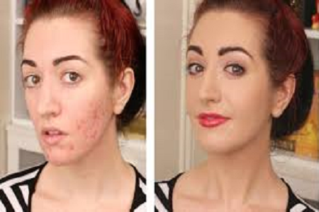 Best Way to Hide and Conceal Acne, Dark Spots and Gray Hairs - JosBuy