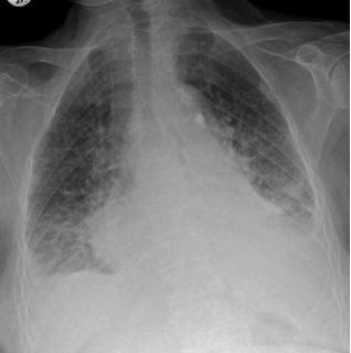 Tugas Sampah Koas: Radiologi-KARDIOMEGALI DENGAN EDEMA PULMONUM DAN ...