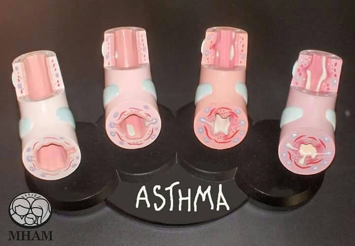 Kenali tahap semput @ asma - | ANAK KEDAH