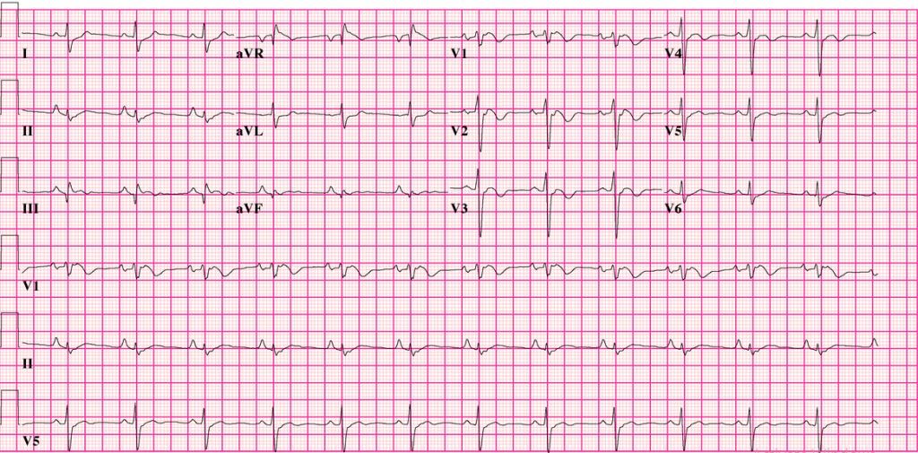 Arrhythmogenic Right Ventricular Cardiomyopathy (ARVC)