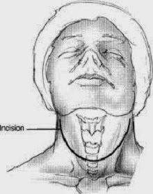 Medical Treatment Pictures-for Better Understanding: Total Laryngectomy ...