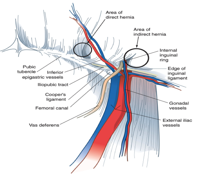INTERNOS DE CIRUGIA FSFB: Hernias de la pared abdominal