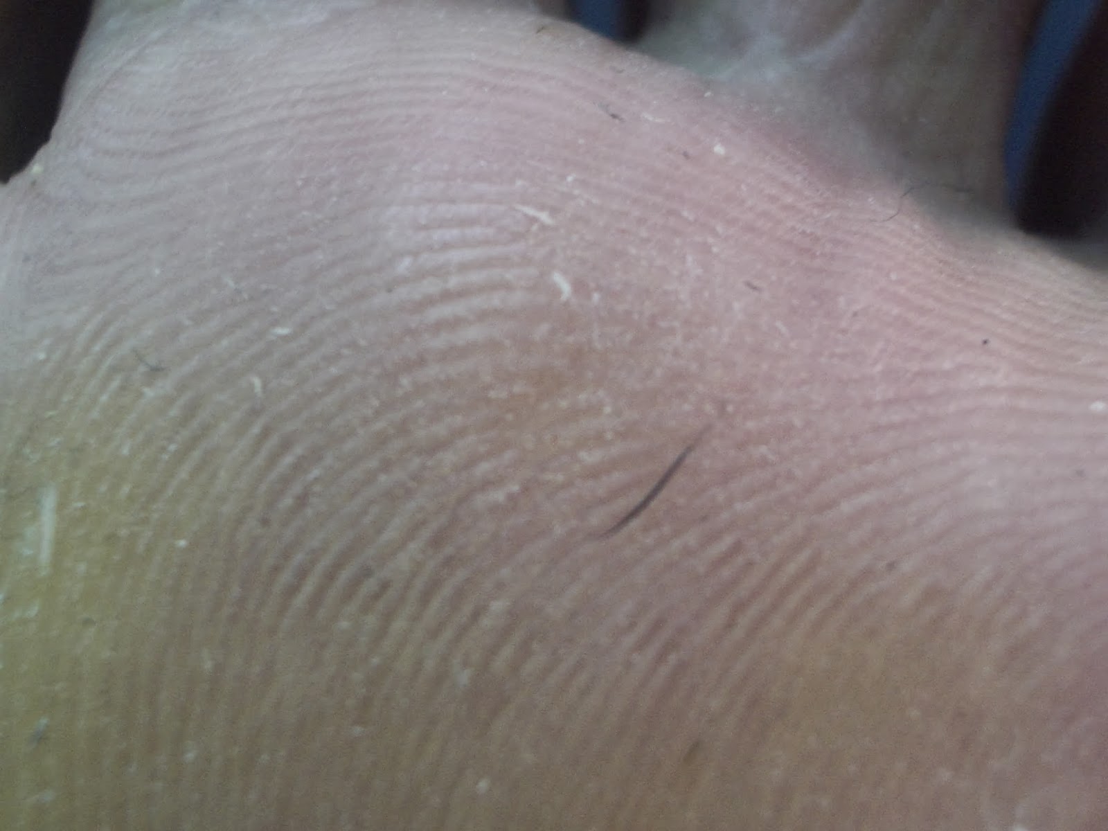 Podo Basas al Día: Pelos clavados en la planta del pie. K.Láser y ...