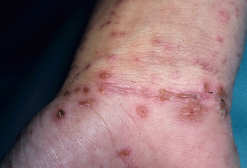 Kesehatan Yang Terlupakan: Penyebab Scabies