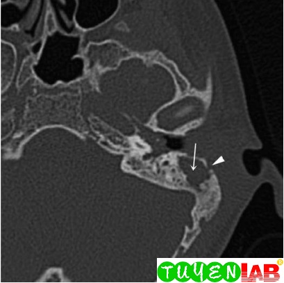 [Pediatric] Atlas of Mastoiditis | Free Medical Atlas