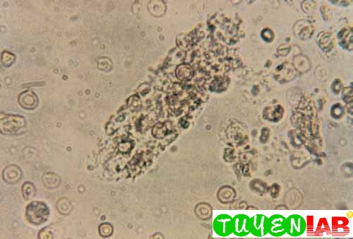Atlas of Casts in urine | Free Medical Atlas