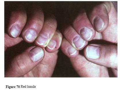 Nail Diseases: Red Nails