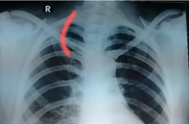 Chest Medicine Made Easy-Dr Deepu: The cervical rib