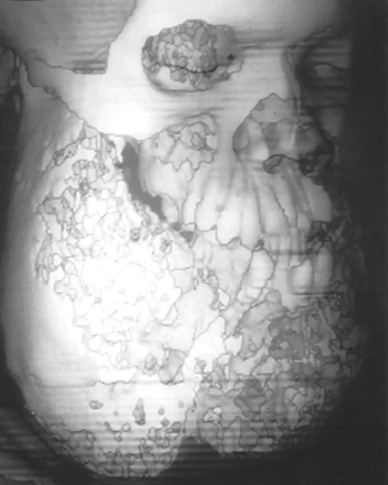 CT/MRI procedures: Cherubism