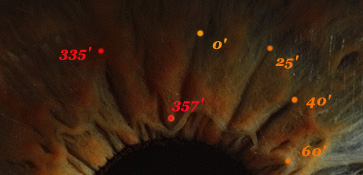 Modern & Multidimensional Iridology: Mixed/Biliary Iris Constitution ...