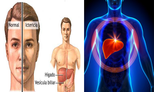 6 señales que pueden ayudan a detectar una insuficiencia hepática