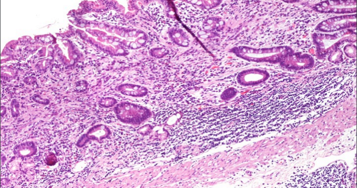 Atlas virtual de histologia e patologia: [CC #6]: GASTRITE