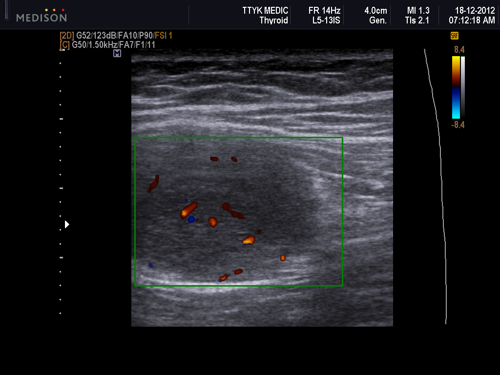 VIETNAMESE MEDIC ULTRASOUND: CASE 159: INTRAMUSCULAR MASS, Dr PHAN ...