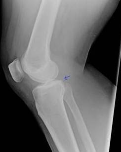 Is it a segond's fracture? - Sumer's Radiology Blog