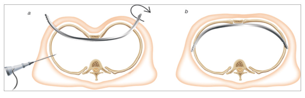 Women With Pectus Excavatum