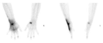 Nuclear Medicine Technology Program: Extravasation