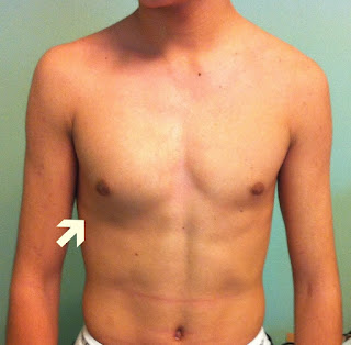 Reumails. Reumatología al día: Caso Clínico. Tumefacción pectoral ...