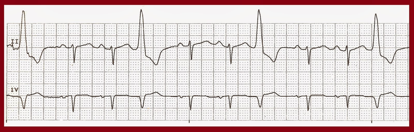 EKG Rhythm Quiz 285