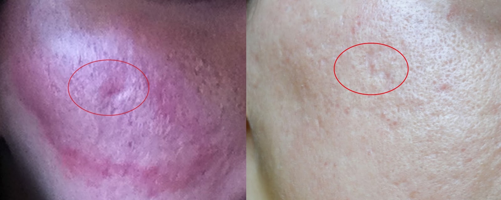 Laser viso acne foto prima e dopo: la mia opinione e come affrontare il ...