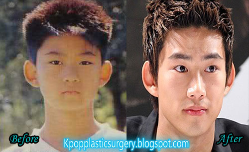 2PM Plastic Surgery Before and After | 2PM Taecyeon Plastic Surgery ...