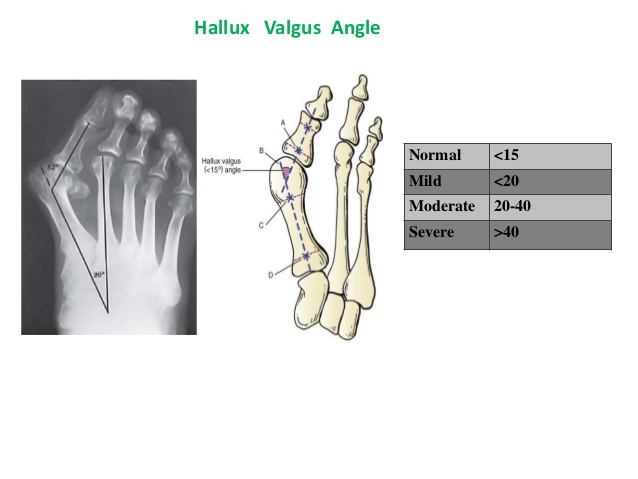 Spine Acupuncture & Hallux Valgus Institute: Βλαισός μέγας δάκτυλος ...