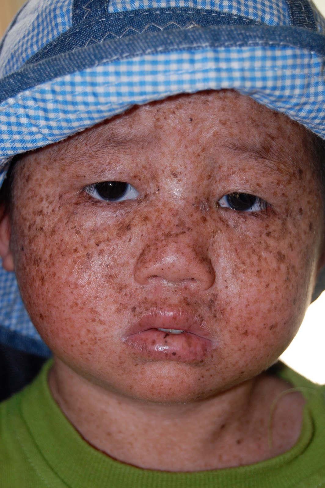 Xeroderma Pigmentosum Pictures Symptoms Treatment And More