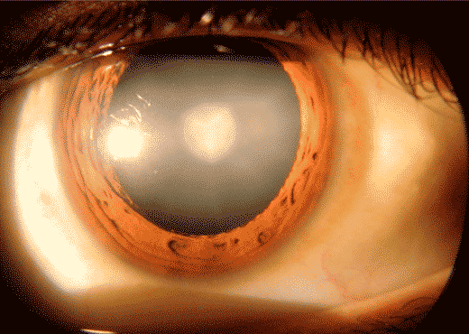 Elementos de Anatomía y Fisiología Humana: El Ojo y la Ceguera