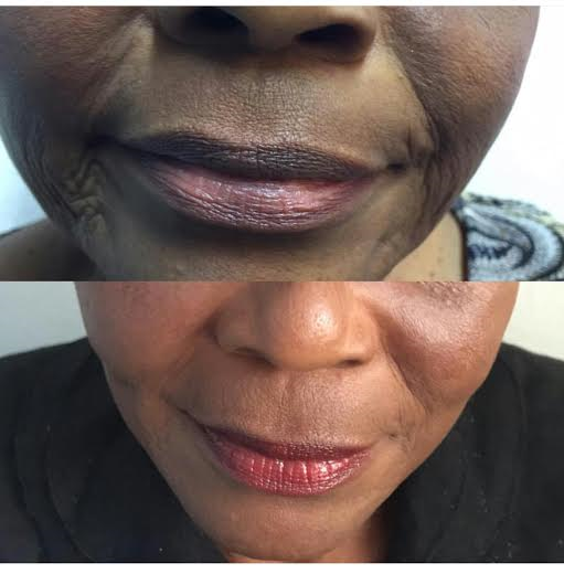 Liposuction, Stretch marks, Gluthathione, Botox, Derma Filer, Hair loss ...