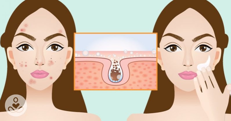 DIY ACNE SCAR FADING MASK