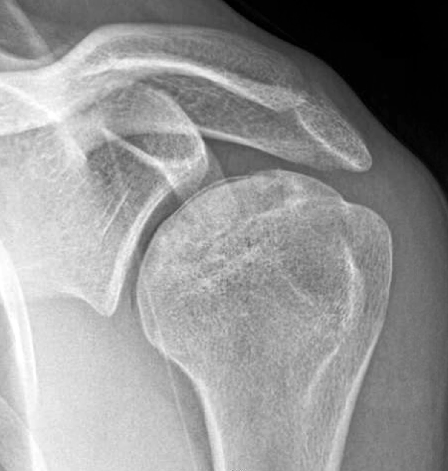 UW Shoulder and Elbow Academy: Shoulder joint replacement - many ...