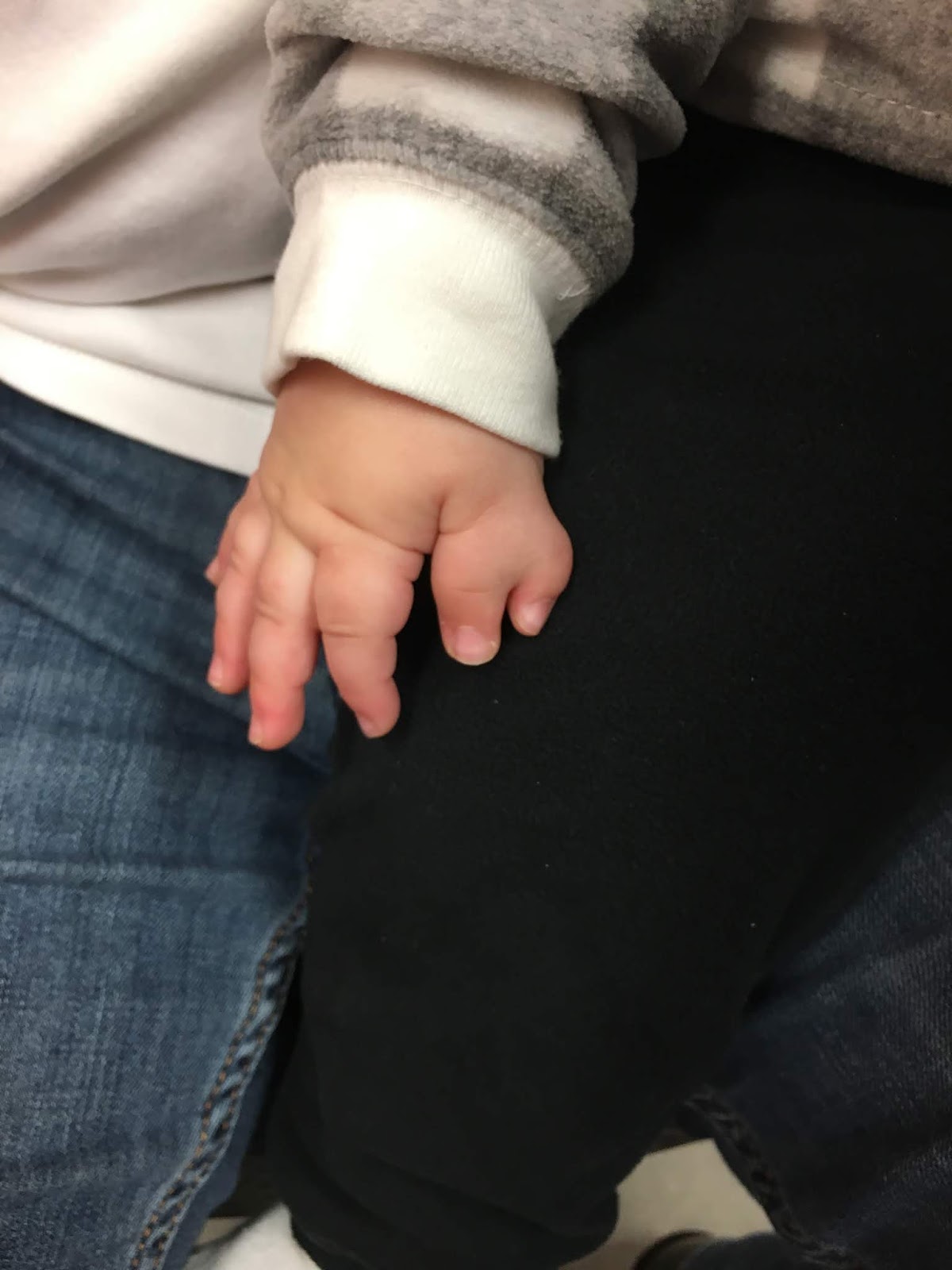 Extra Thumb Reconstruction | Congenital Hand and Arm Differences ...