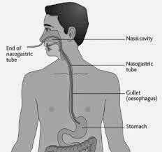 nasaruddinmuhammad.blogspot.com: Prosedur Pemasangan NGT