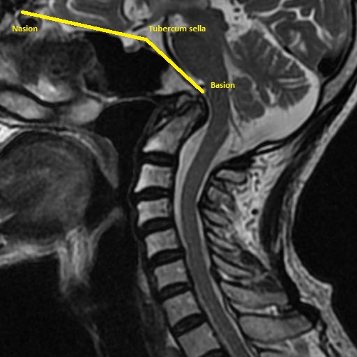Dr Balaji Anvekar FRCR: Platybasia with Basilar invagination