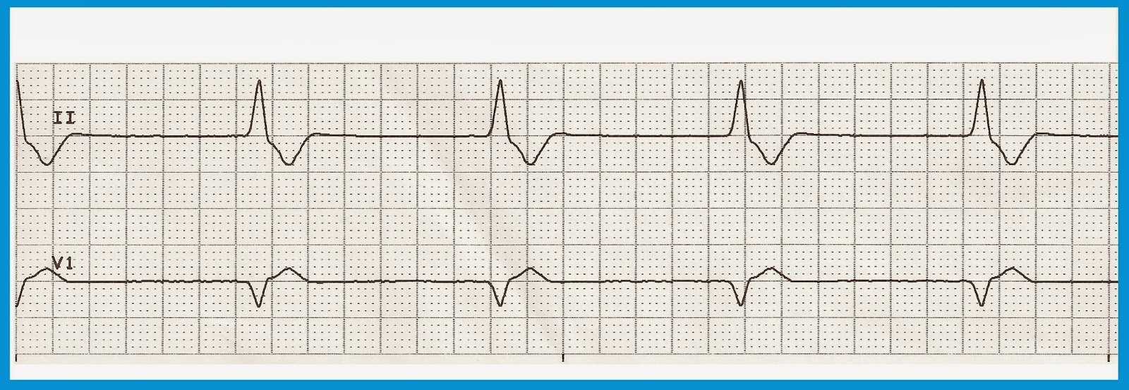 EKG Rhythm Strip Quiz 191