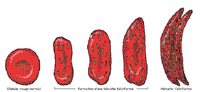 La drépanocytose Symptômes et Causes | SVT & Biologie