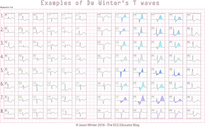 ECG Educator Blog : De Winters T waves