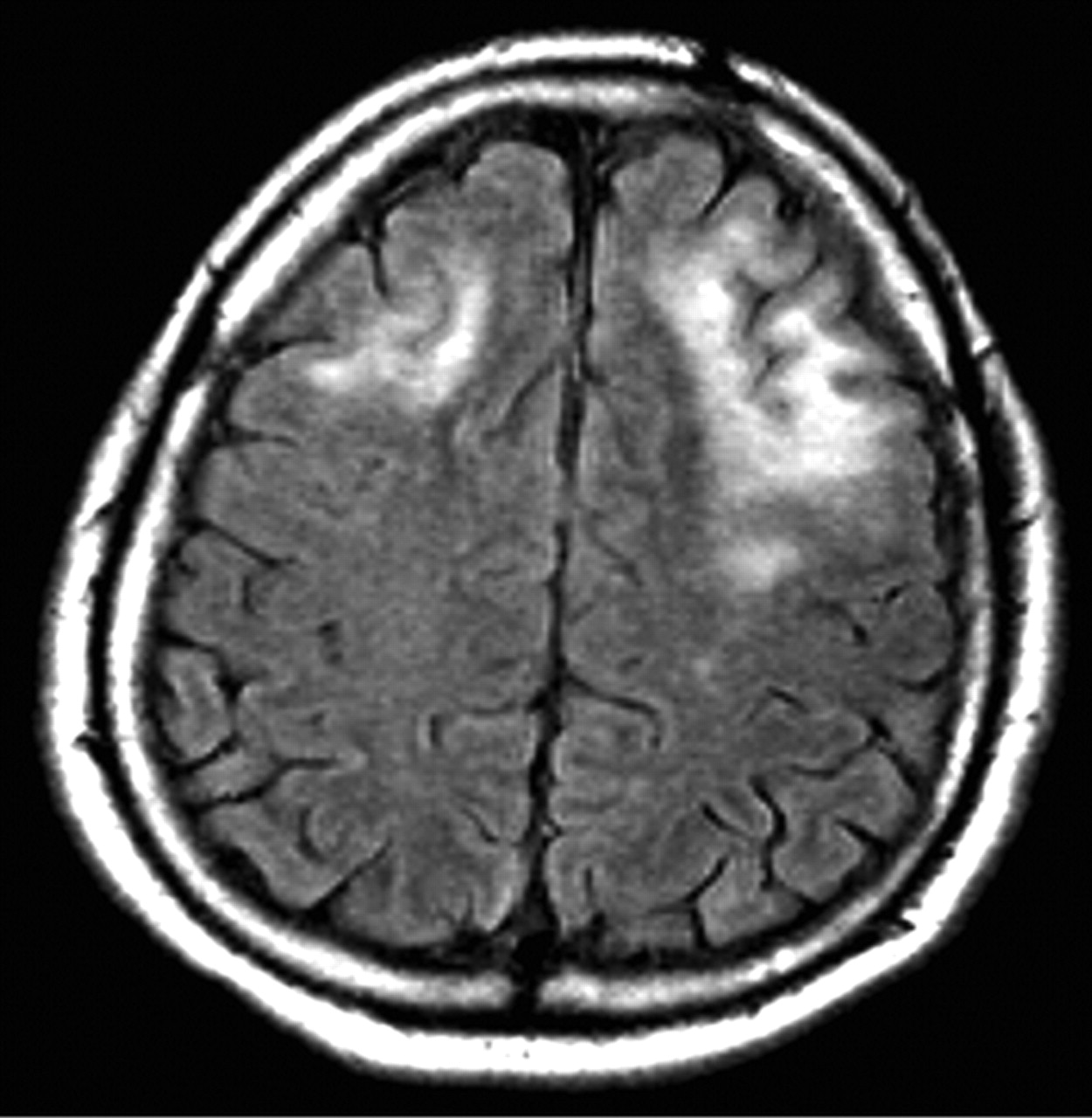 Esclerosis Multiple Msblog What Next In Natalizumab Pml Survivors Qué Sigue En Pacientes