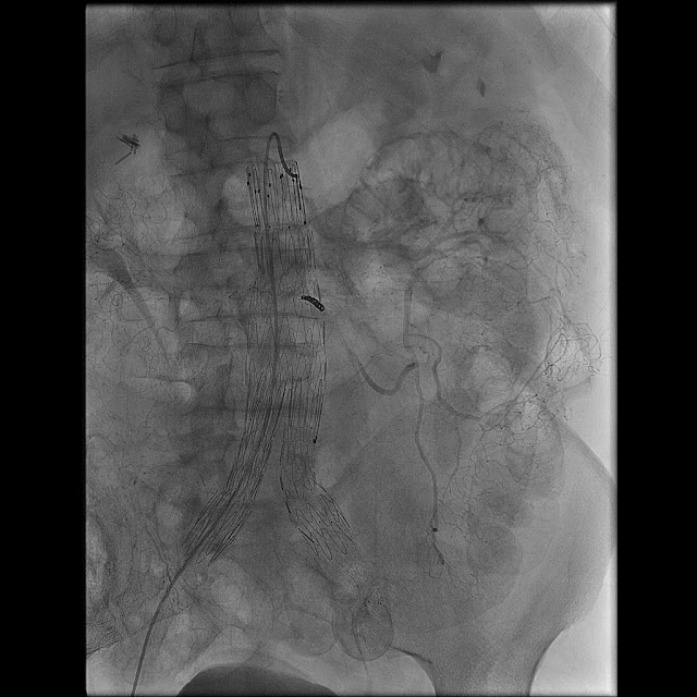 The Pump and the Tubes: Arc of Riolan / "meandering mesenteric artery"